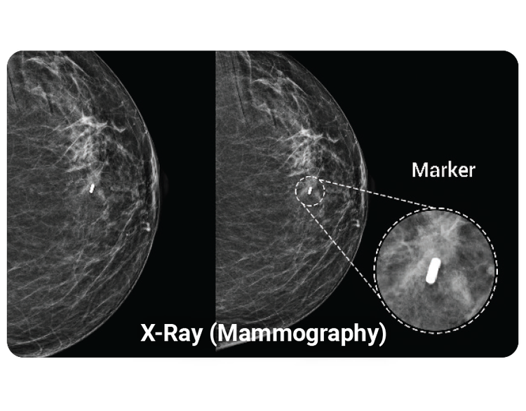 Pintuition® System | Mammotome